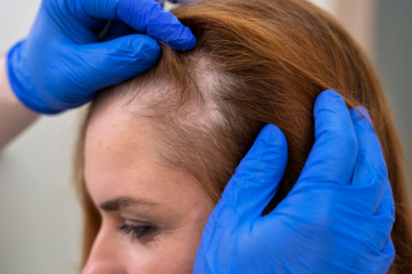 Regenera Activa vs PRP - Know Which Hair Loss Treatment is Right For You