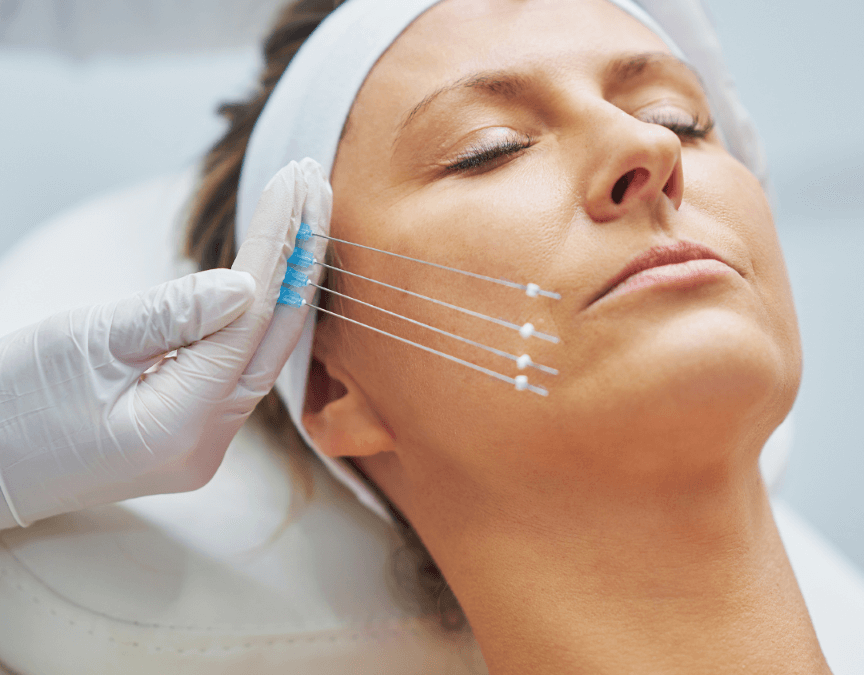 10 Thread Lift Myths Debunked: Fact vs Fiction